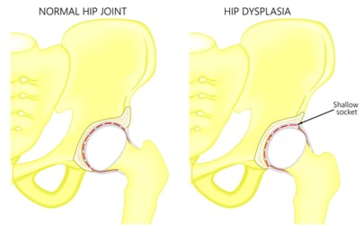 Hip Conditions: Dysplasia